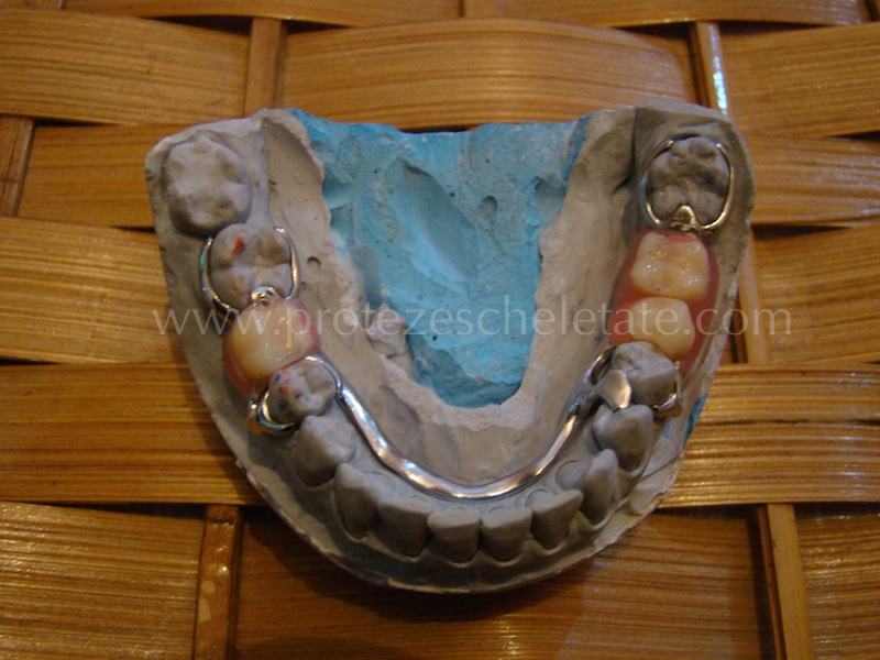 Caz- 9 | Proteze Scheletate