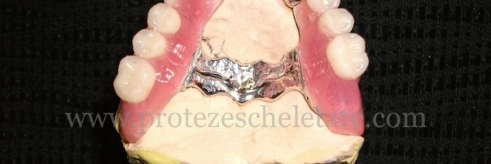 Proteze Scheletate, Page 2 | Proteze Scheletate