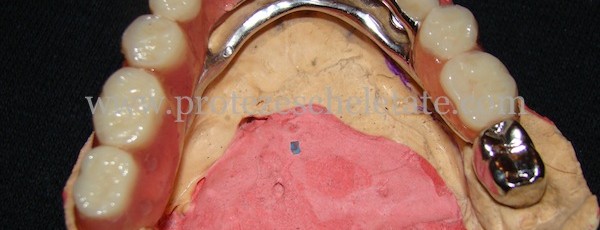 Proteze Scheletate | Proteze Scheletate