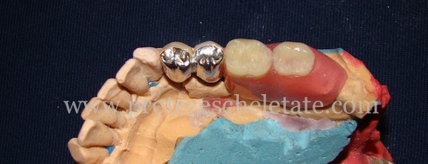 Proteze Scheletate | Proteze Scheletate